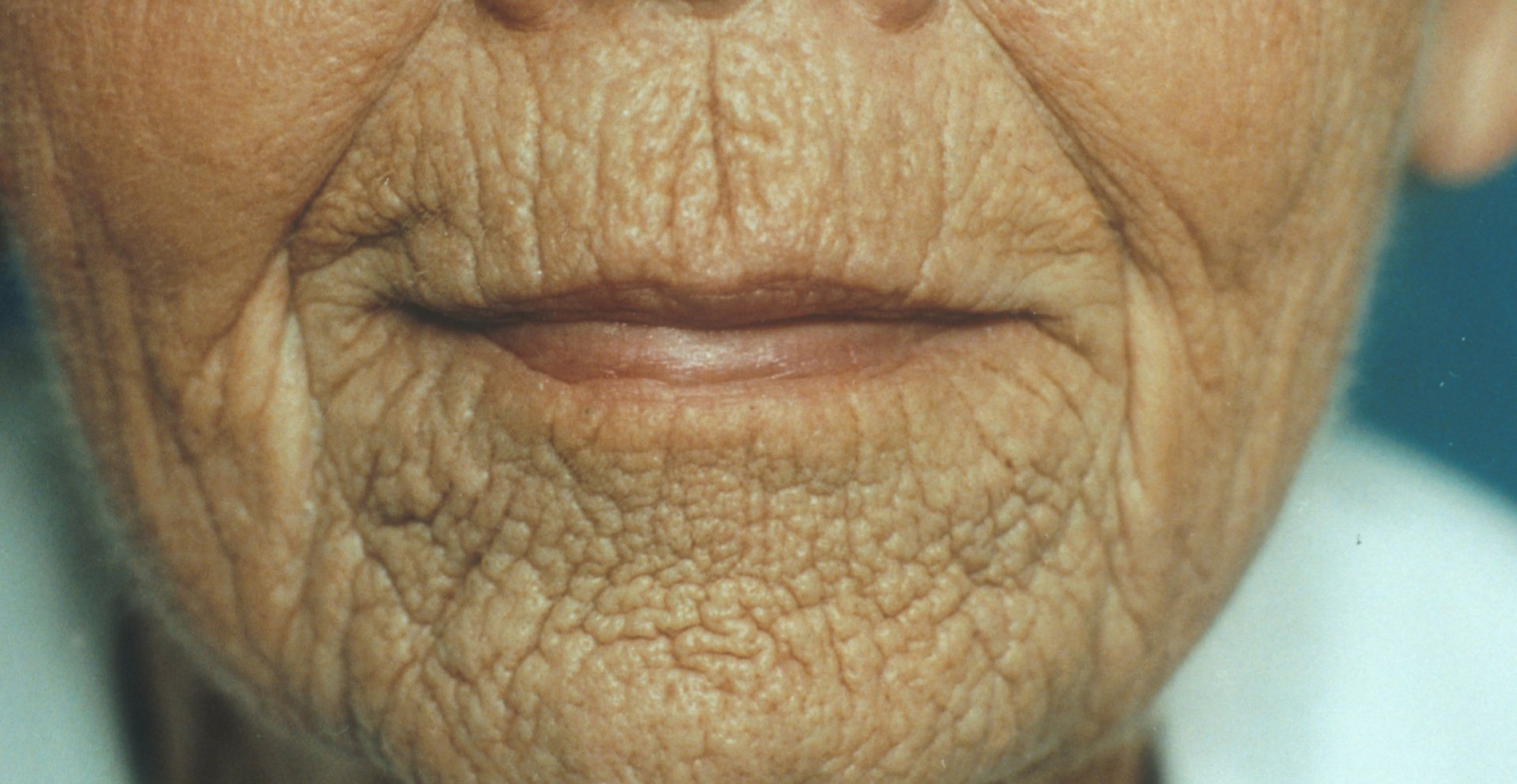 What is Glycation and why do some of us get it as we age? - Laser Skin ...